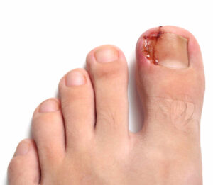 ¿Qué es la onicocriptosis? – Homo medicus