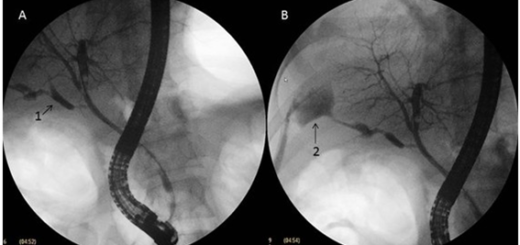 ¿Qué es la estenosis biliar? - Cirugía - Homo medicus