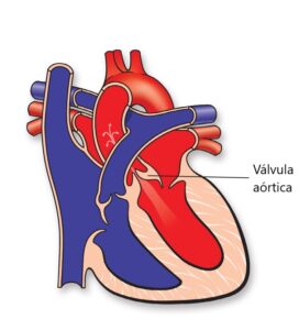 ¿Qué es la insuficiencia aórtica? – Homo medicus
