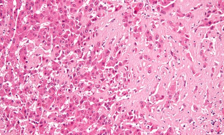 ¿Qué es la amiloidosis? - Hematología - Homo medicus