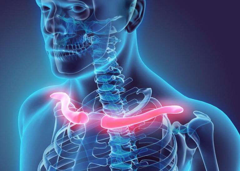 ¿Cómo se clasifican las fracturas de clavícula? – Homo medicus