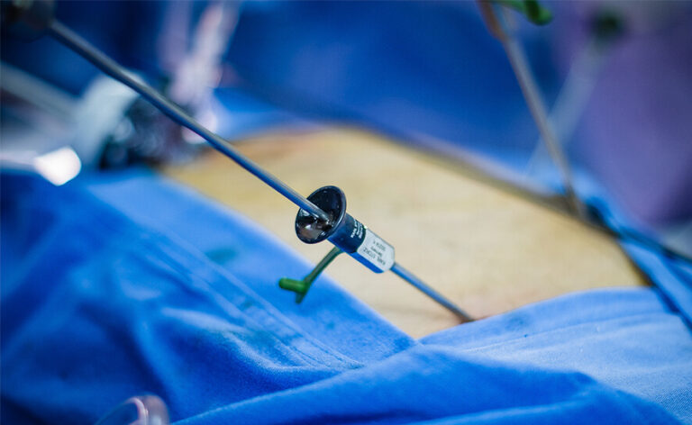 ¿Que son la Minilaparoscopía y las técnicas de mínima invasión en ...