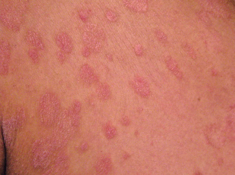 ¿Qué es la pitiriasis rosada? – Homo medicus