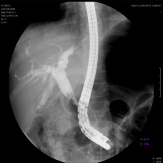 ¿Qué es la estenosis biliar? – Homo medicus