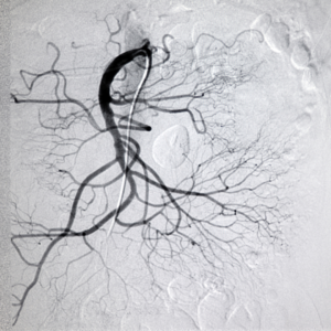 Arteriopatía mesentérica: ¿Cuál es la causa? – Homo medicus