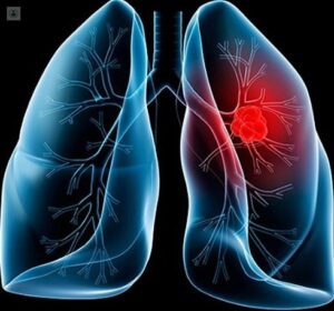 ¿Qué son los abscesos pulmonares? – Homo medicus
