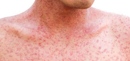 El virus de Epstein-Barr, ¿qué enfermedad causa?