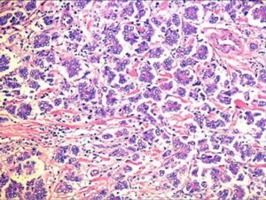 ¿Cuáles son los tipos de colangiocarcinoma por su forma de crecimiento ...