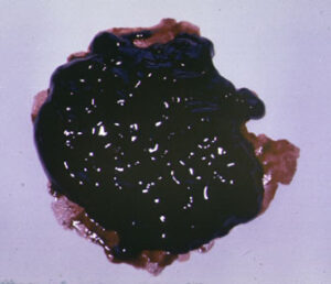 Diferencia entre melena y hematoquezia – Homo medicus