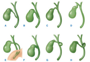 Variaciones del conducto cístico – Homo medicus