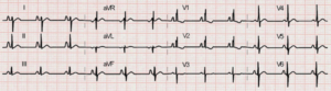 EKG en pacientes con defecto del septo auricular