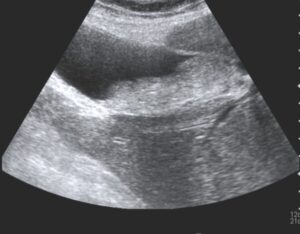 Utilidad de la ecografia en la obstrucción de colédoco