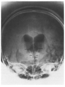 ¿Qué es el síndrome de Nothnagel? – Homo medicus