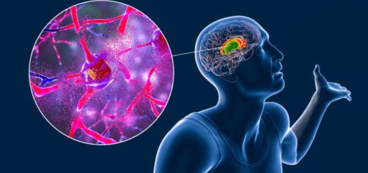 ¿Qué es la enfermedad de Huntington? - Homo medicus