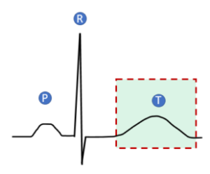 ¿Qué representa la onda T del electrocardiograma? – Homo medicus