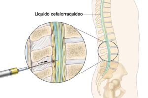Administración intratecal de medicamentos – Homo medicus